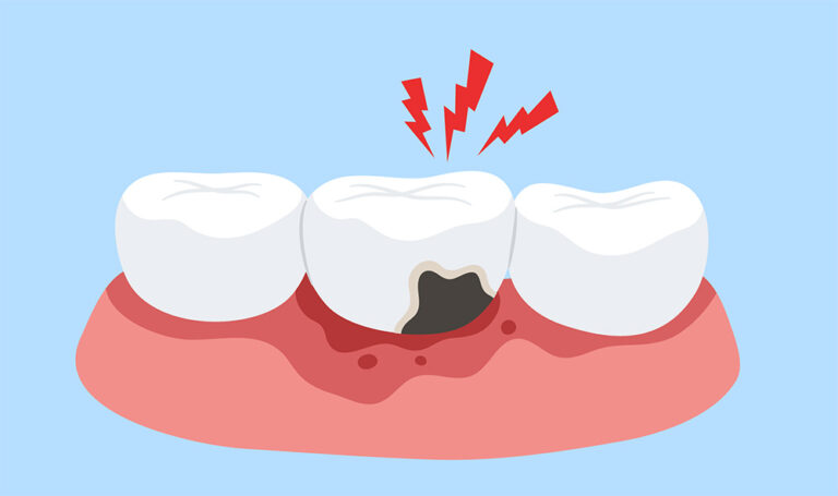 What is a Cavity | Cavity Symptoms | The Dentist at 70 Pitt St