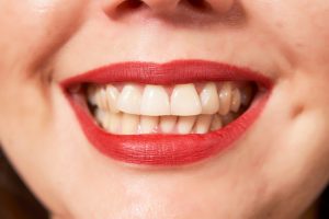 Crooked Teeth: Understanding the Causes and Treatment Options