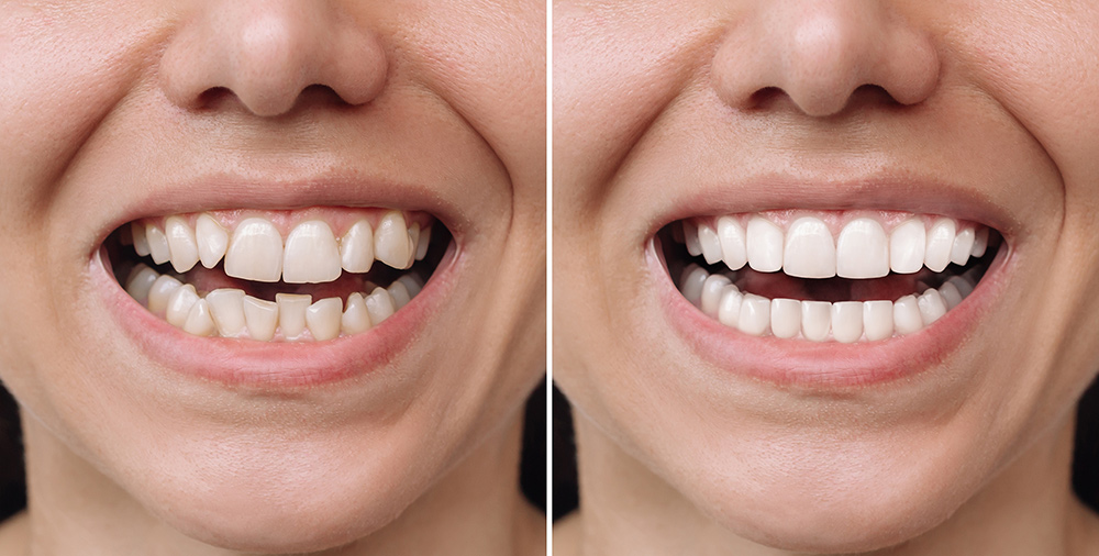 Crooked Teeth: Understanding the Causes and Treatment Options