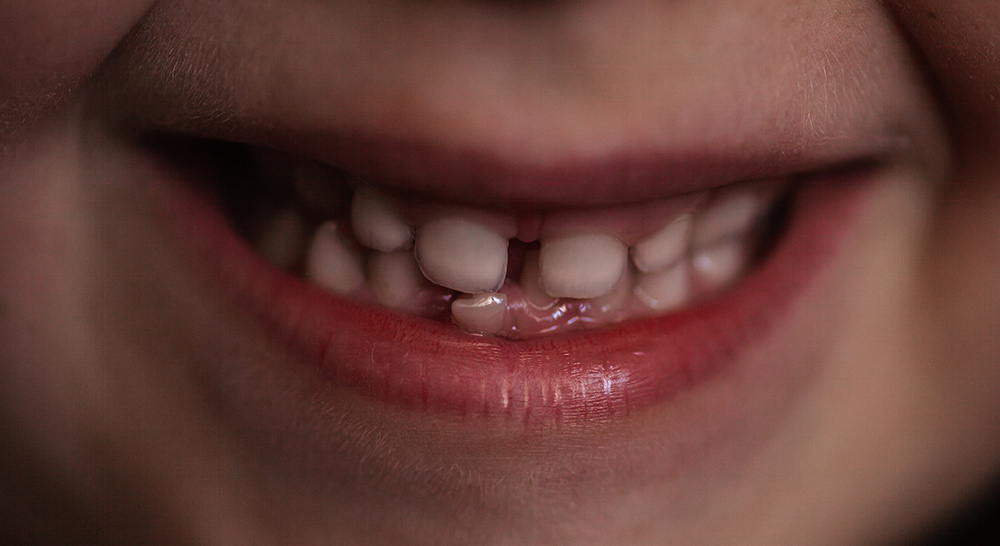 The 5 Stages of Tooth Decay Explained